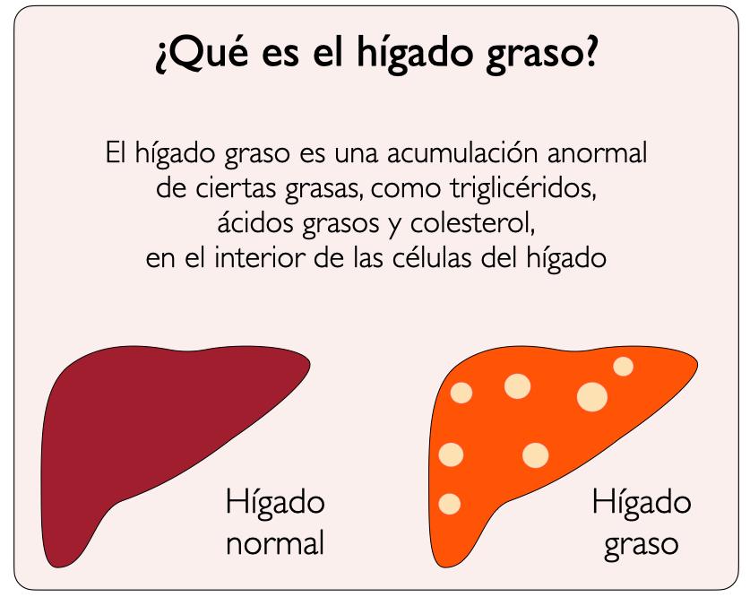 Artículo: Todo lo que necesita saber sobre el hígado graso – Farmacia ...